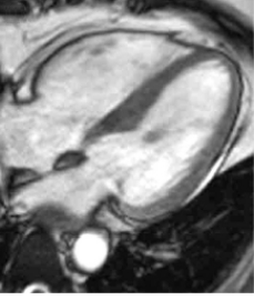 Diagnosing Hypertrophic Cardiomyopathy | Expose HCM